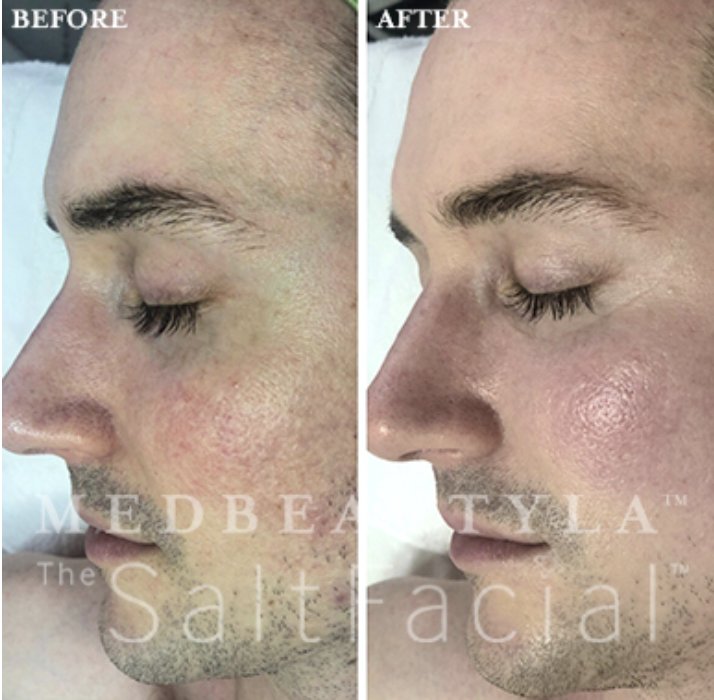 The SaltFacial: Everything You Need to Know About It