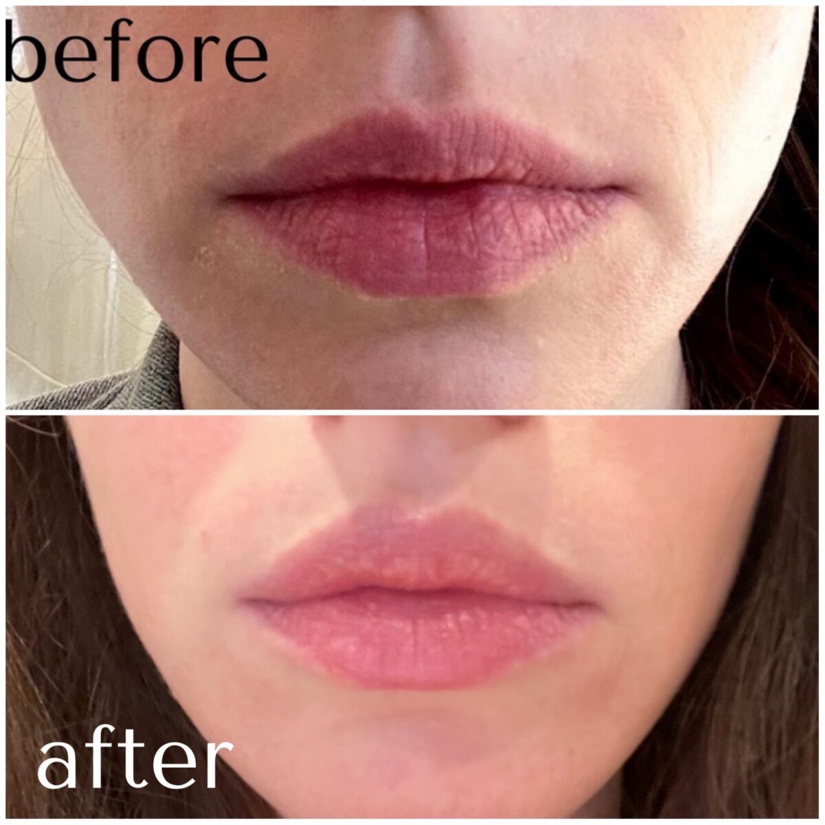Natural-Looking Lip Filler Before and Afters - MedBeautyLA