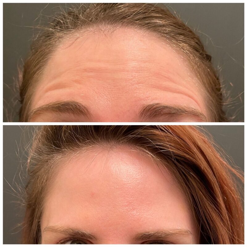 Daxxify Review: Daxxify Before and After Photos