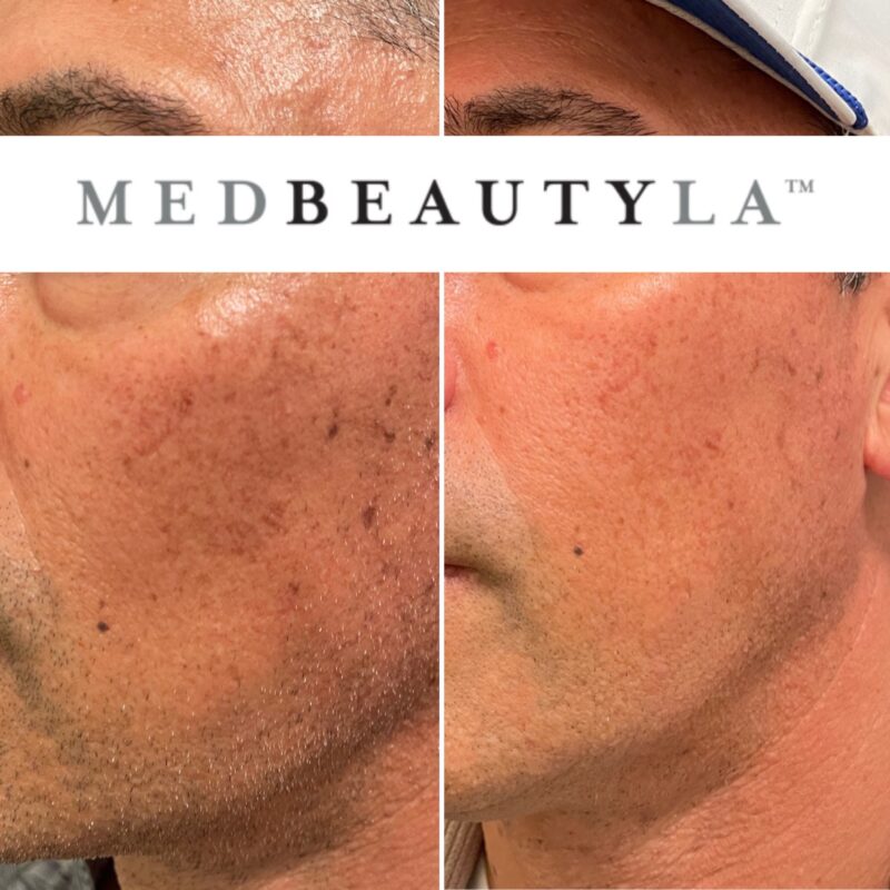 ResurFX Before and After: Our Clinic's Results