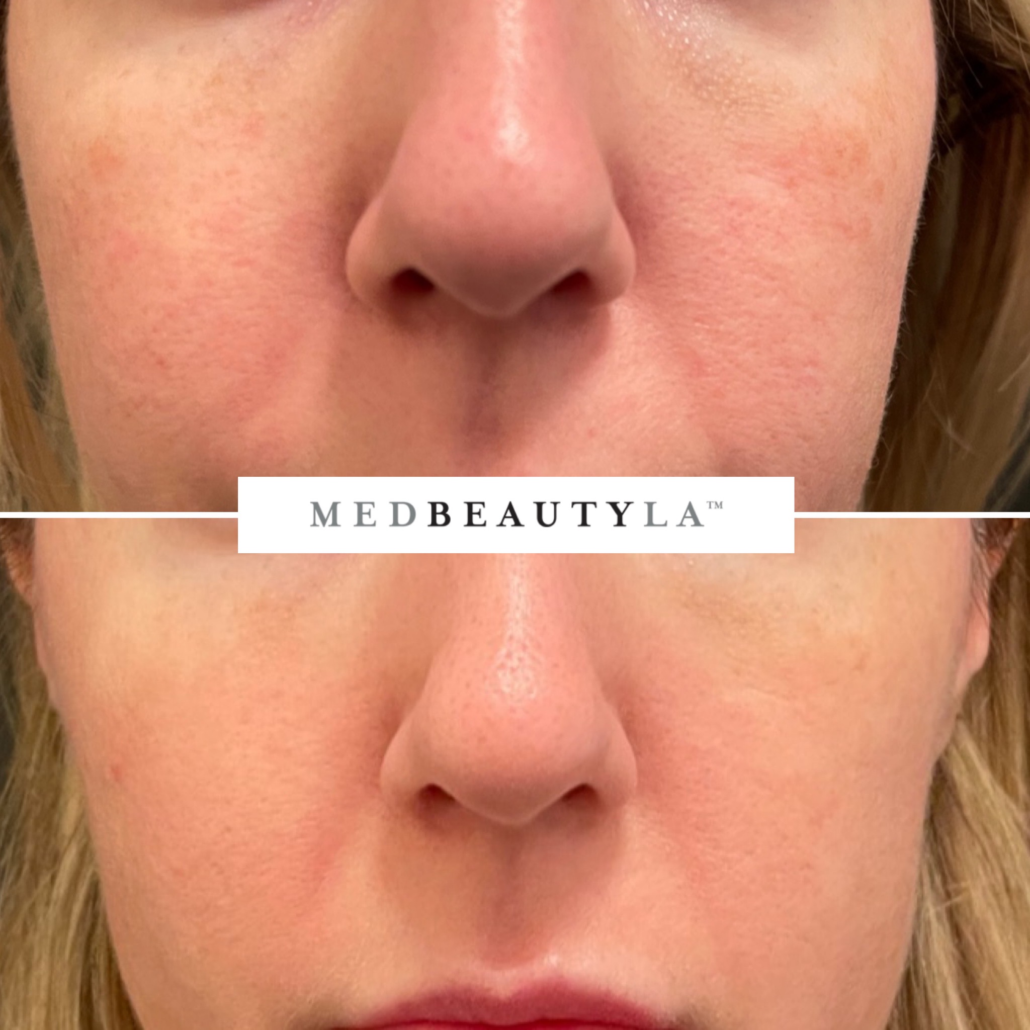 ResurFX Before and After: Our Clinic's Results