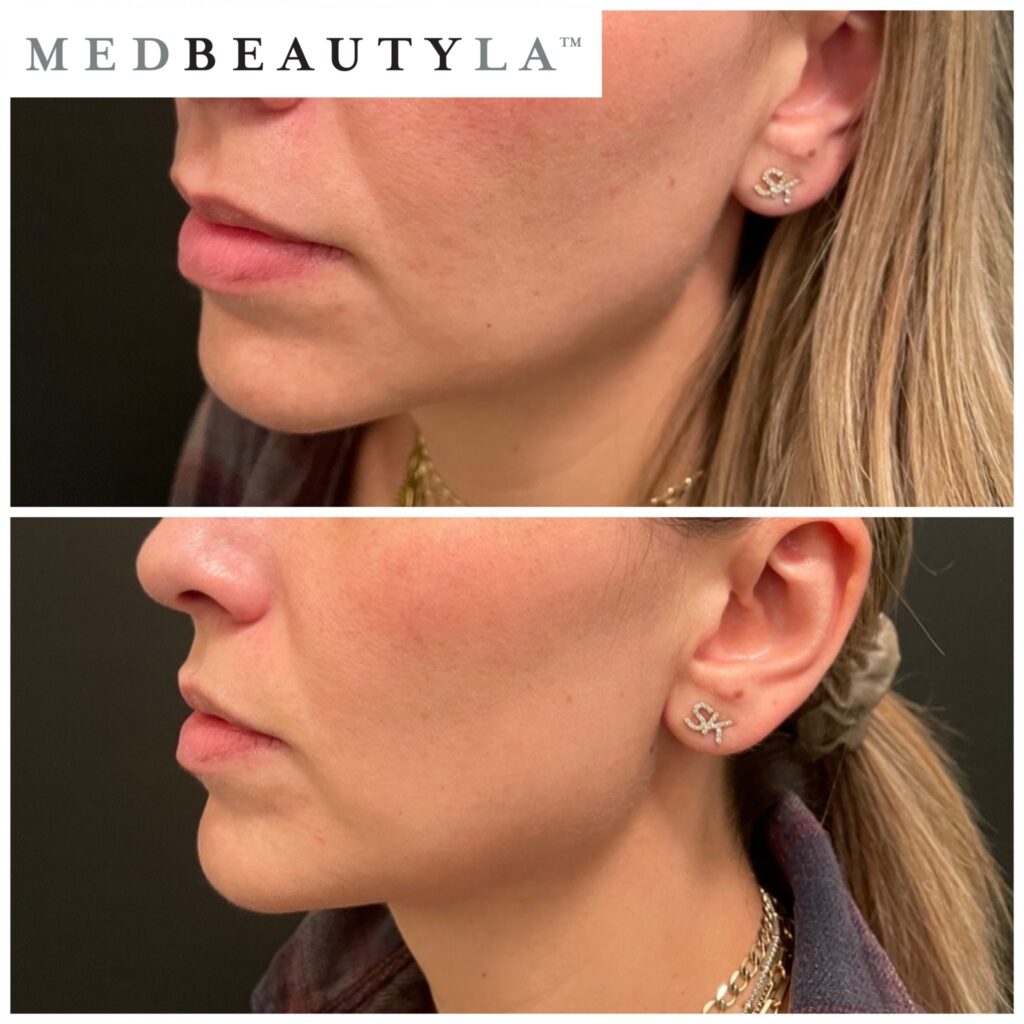 Kybella Before and After Photos: Real Patient Results