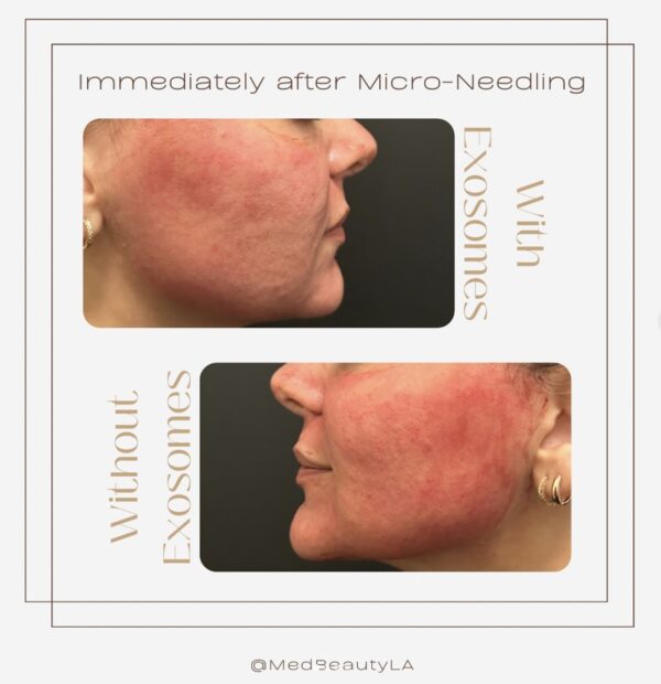 Microneedling Exosomes Before and After Photos - MedBeautyLA