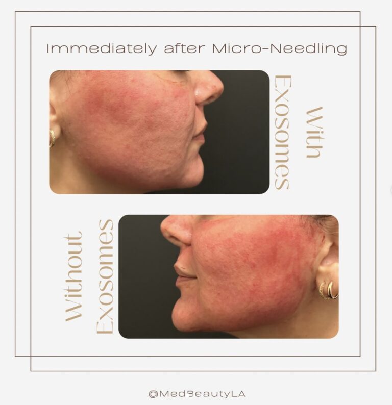 Microneedling Exosomes Before and After Photos - MedBeautyLA Microneedling Exosomes Before and After Photos - MedBeautyLA