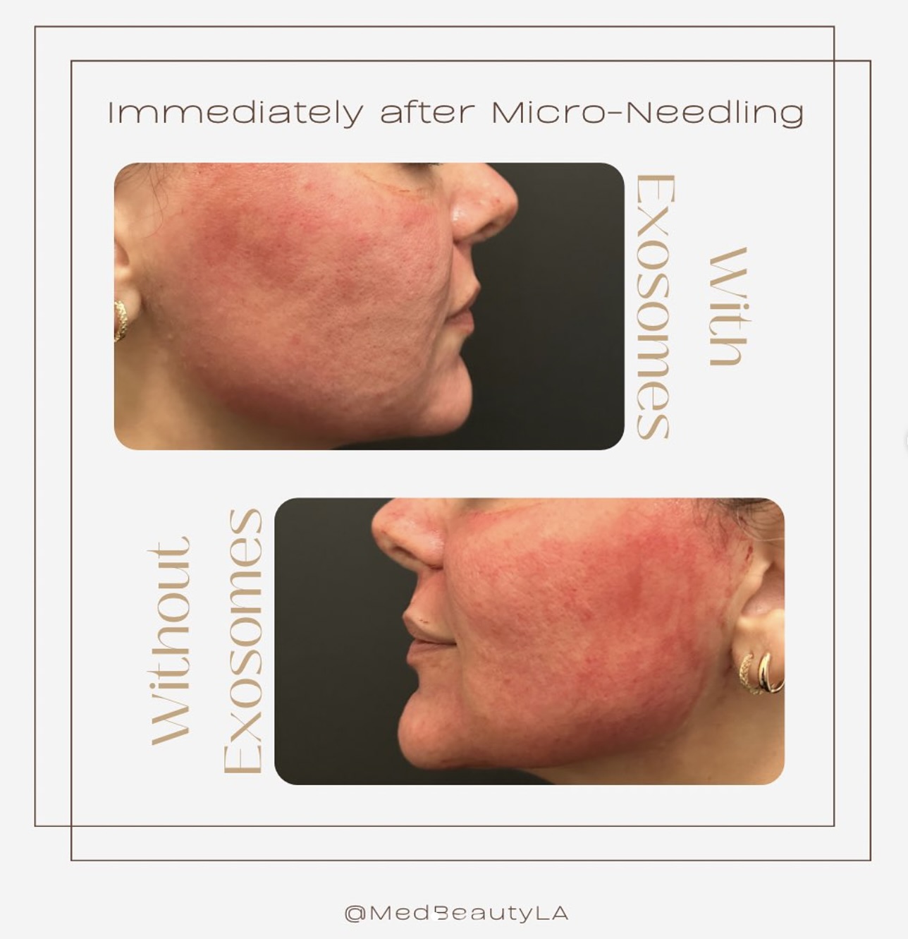 Microneedling Exosomes Before and After Photos - MedBeautyLA