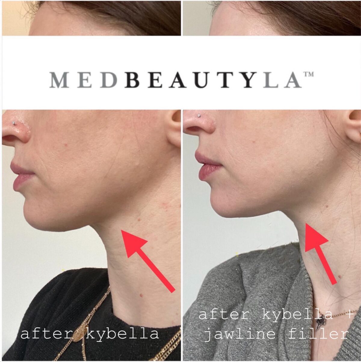 Kybella Before and After Photos: Real Patient Results