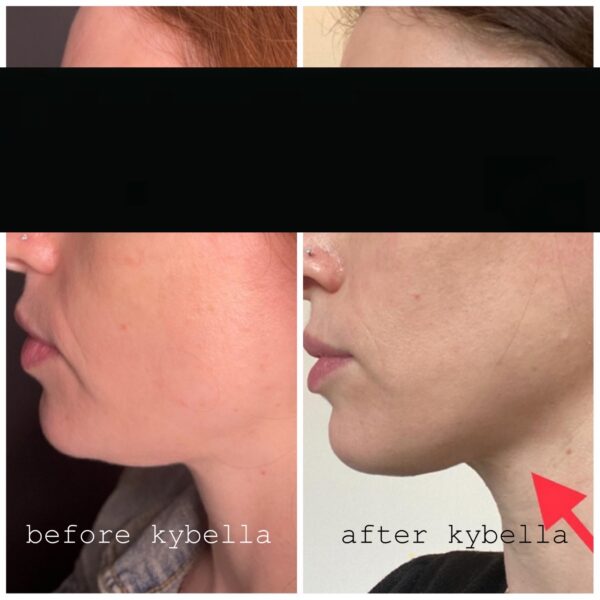 Kybella Before and After Photos: Real Patient Results