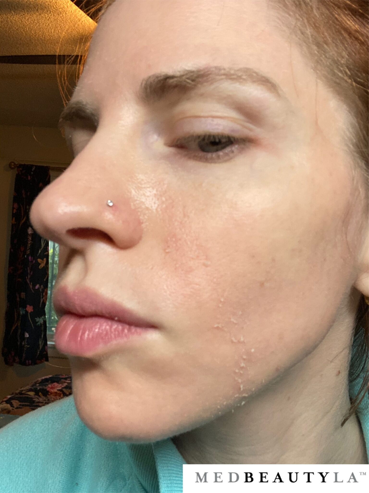 Makeup After Microneedling? Microneedling Questions Answered