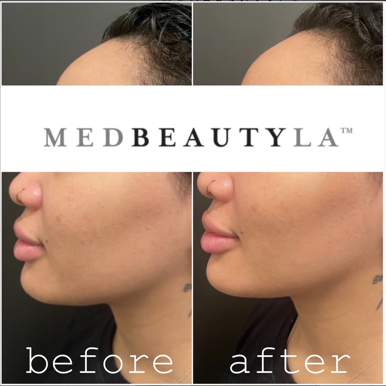 Facial Balancing Before and Afters LA