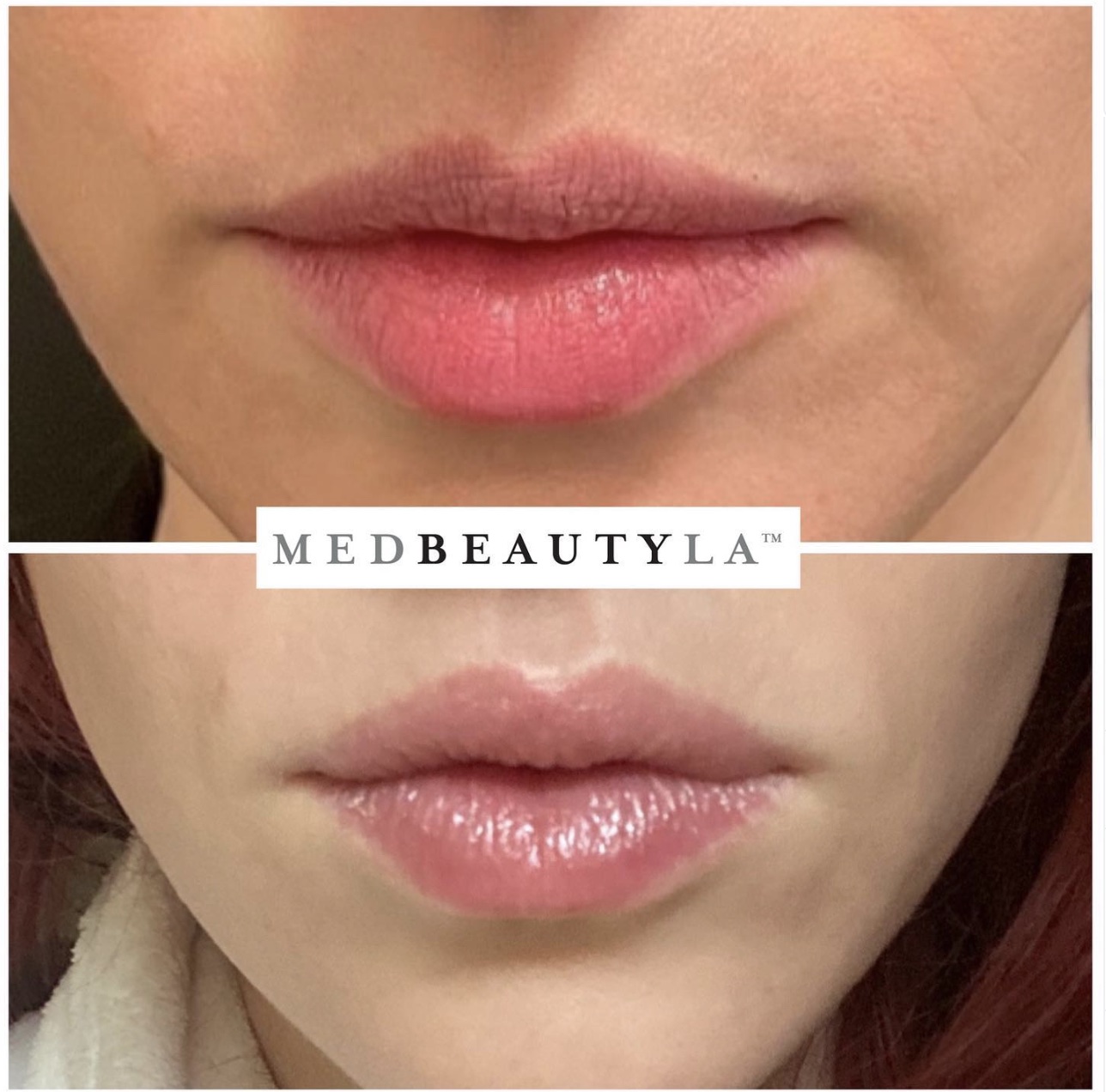 Facial Balancing Before and Afters LA