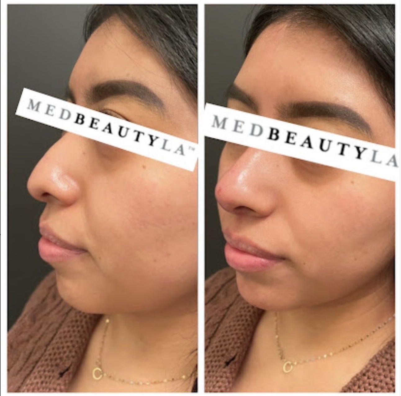 Facial Balancing Before and Afters LA
