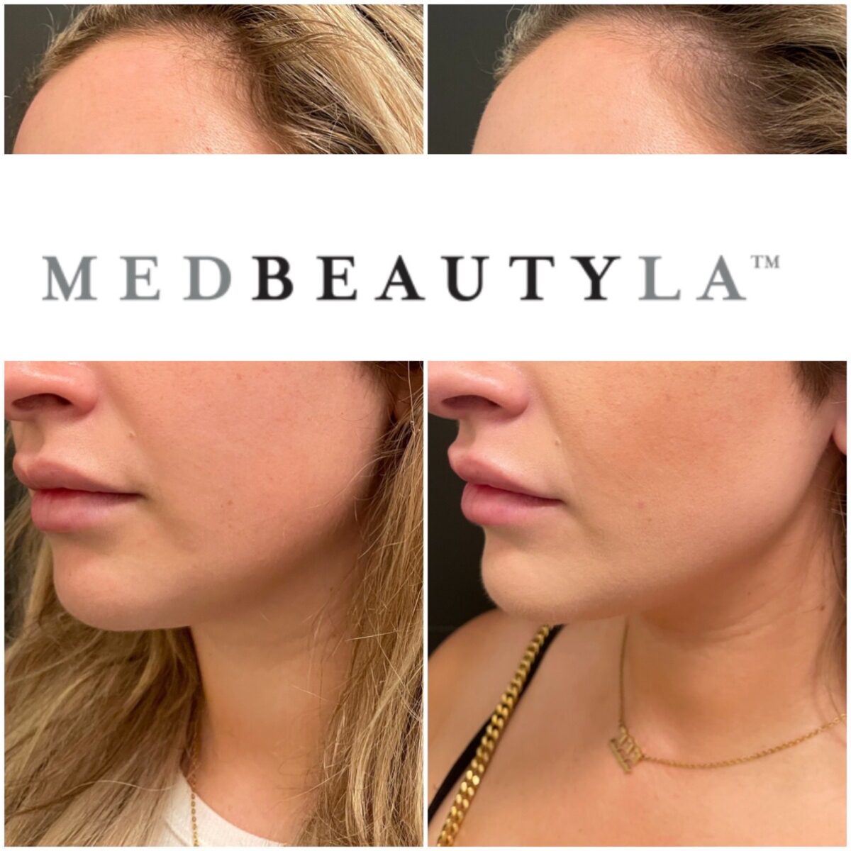 Best Facial Balancing Los Angeles