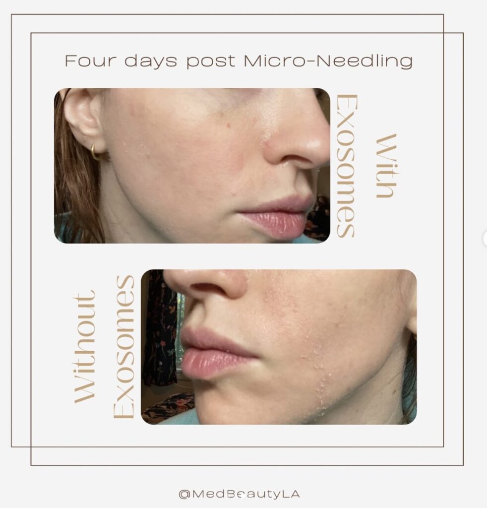 Microneedling with Exosomes in LA: MedBeautyLA