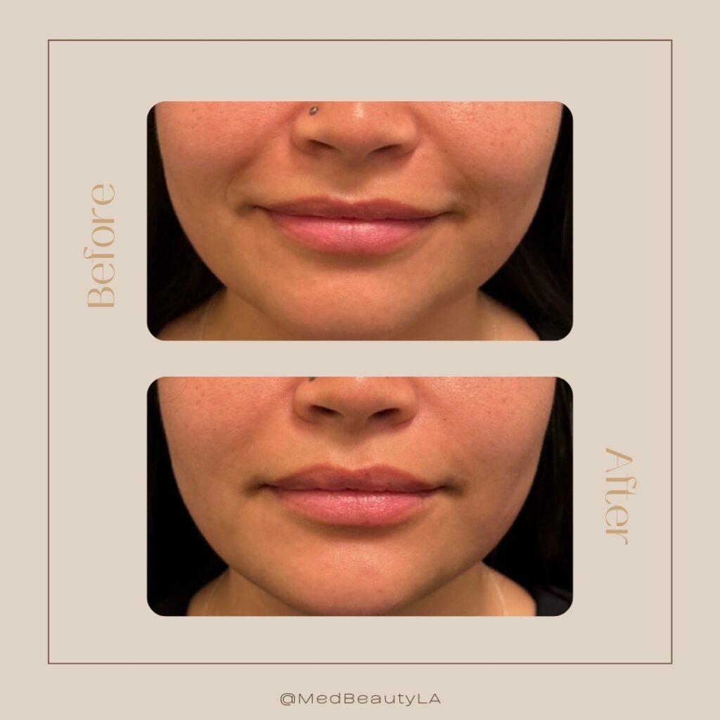 Lip Flip Botox®: Before and Afters