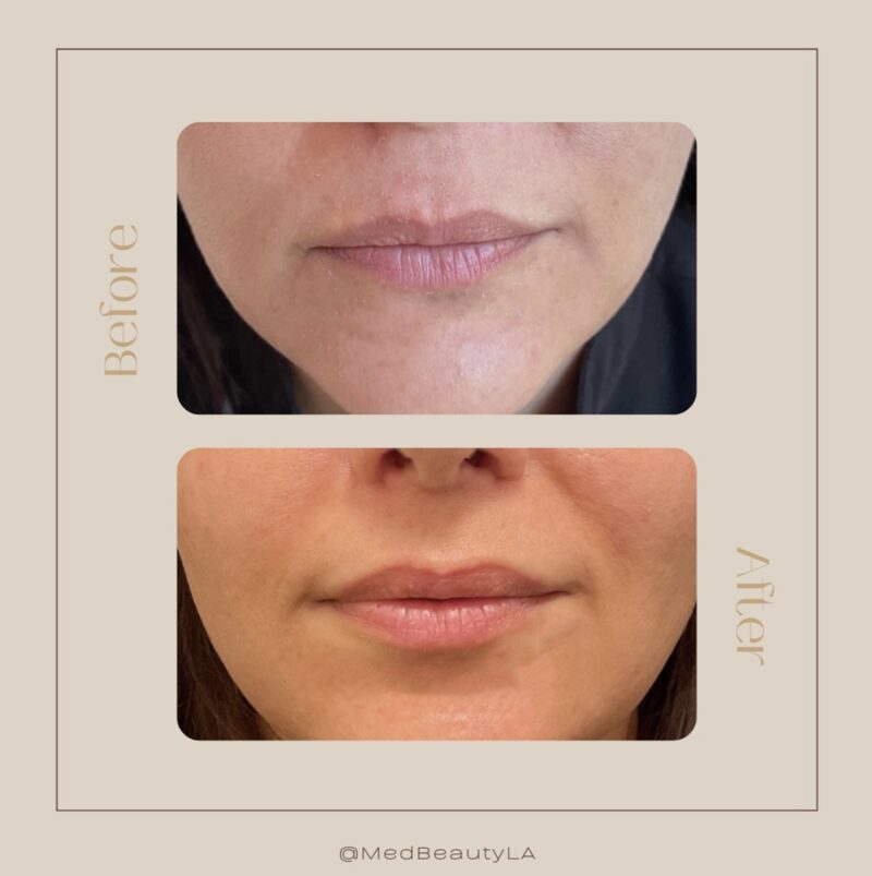 Lip Flip Botox®: Before and Afters
