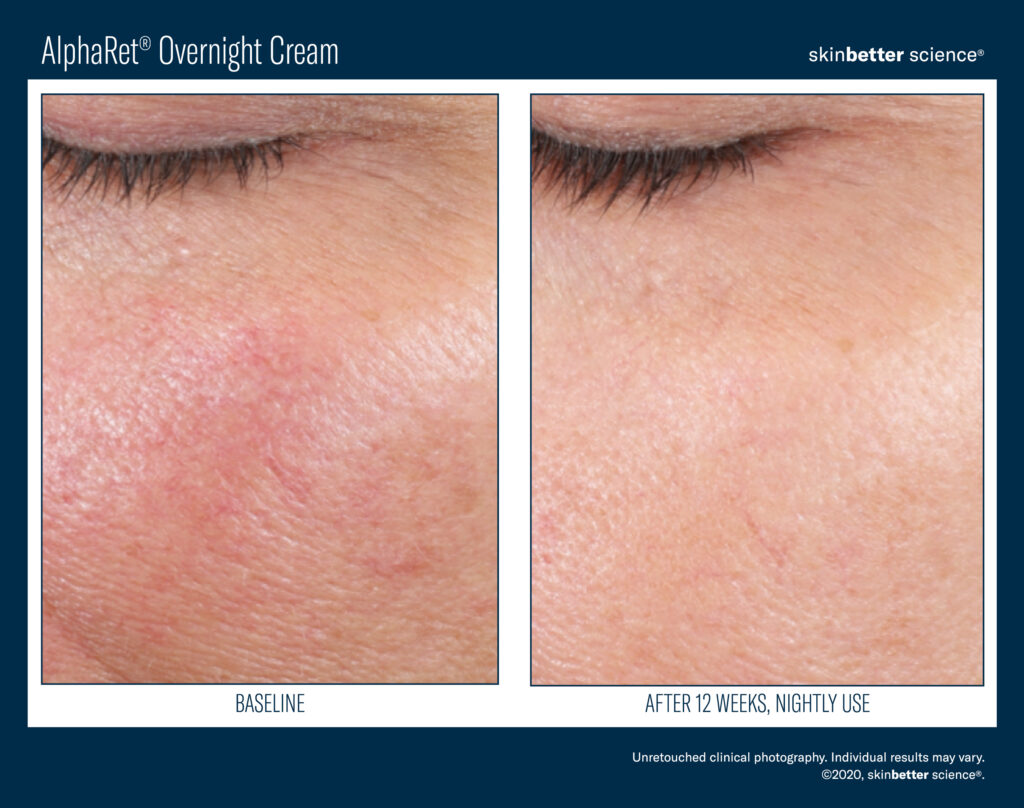 Why SkinBetter Science’s AlphaRet Is Our Top Retinol Pick